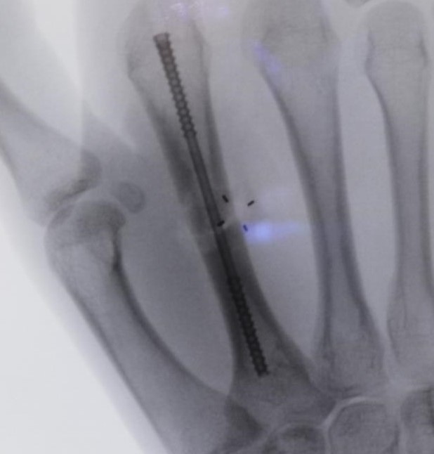 Use of NX Nail for oblique fracture fixation of 2nd metacarpal
